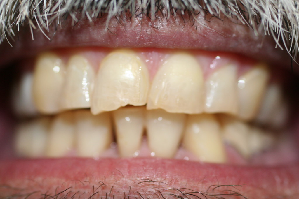 Six Month Braces | Pearl Cosmetic DDS